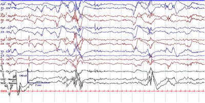 Normal Eeg Tracing